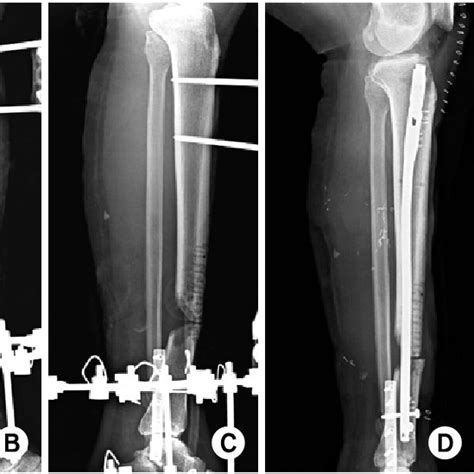 A 56 Year Old Female With Gustilo Anderson Type Iiib Open Fracture On Download Scientific