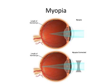 Prescribing For Refractive Errors