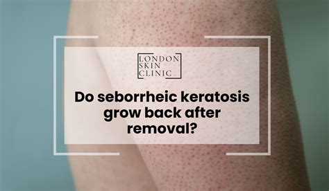 Do Seborrheic Keratosis Grow Back After Removal London Skin Clinic