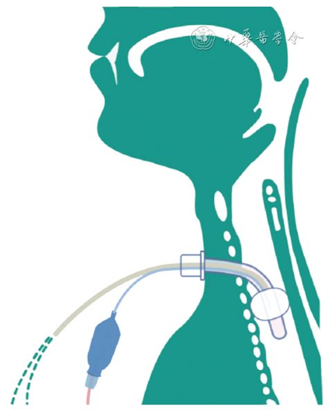 气管切开患者的管理和康复治疗推荐意见 科研资讯 国家呼吸系统疾病临床医学研究中心