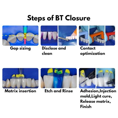 Bioclear Black Triangle Bt Matrix System Kit