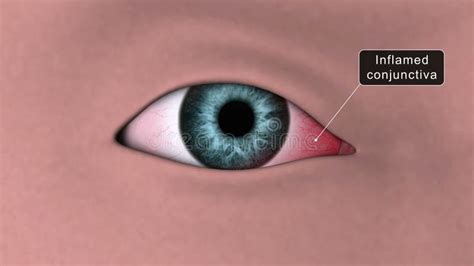 Biomedical Animation Of Conjunctivitus In Human Eye Stock Video Video Of Eyeball Closeup