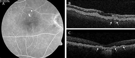 Amd Consensus Nomenclature Explained 47 Off