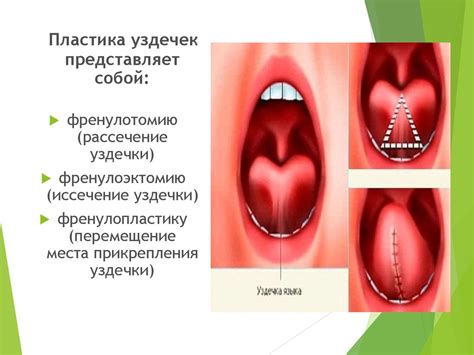 Виды уздечек Показания к пластике уздечке языка презентация онлайн