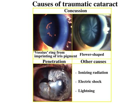 Ppt Ophthalmology Cataracts Powerpoint Presentation Free Download