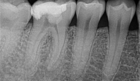 The Evidence Base For Pulpotomy In Irreversible Pulpitis The Harley