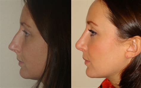 Reshaping Redefining Resizing Nose With Nose Surgeryrhinoplastynose