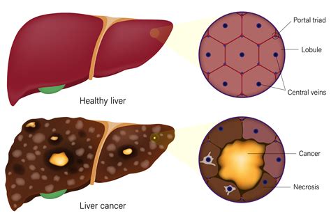 Liver Cancer Awareness Month Signature Health Services