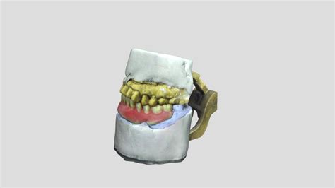 Single Denture Prothesis Case A 3d Model Collection By Omar Eiada