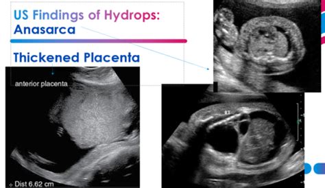 Fetal Hydrops Flashcards Quizlet