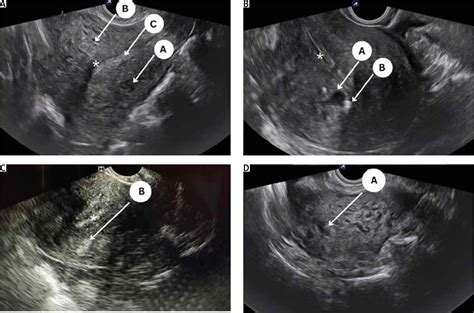 New Musa Classification Of Adenomyosis Correlation Of Symptoms And
