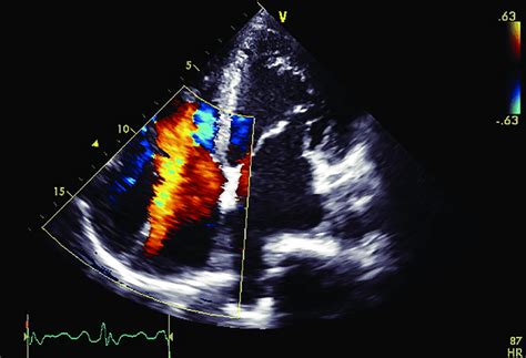 Transthoracic Echocardiography In An Apical Four Chamber View With
