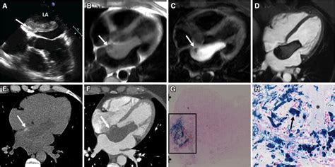 Typical Presentation Of A Cm In The Left Atrium La Tee A