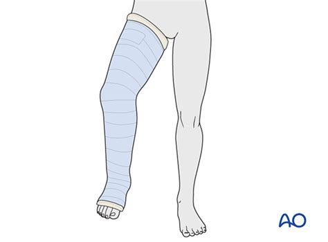 Long Leg Cast