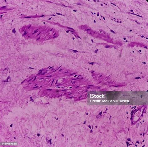 Urinary Bladder Cancer Transitional Cell Carcinoma Show Malignant