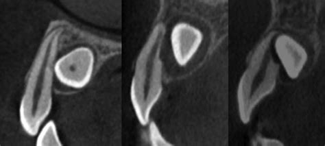 Example Of Root Resorption Definitions In Cone Beam Computed Tomography Download Scientific