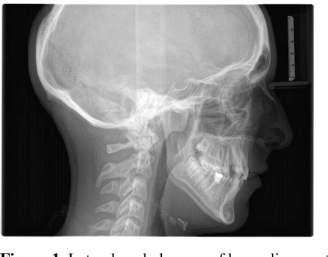 Figure 1 From The Influence Of Mandibular Divergence On Facial Soft