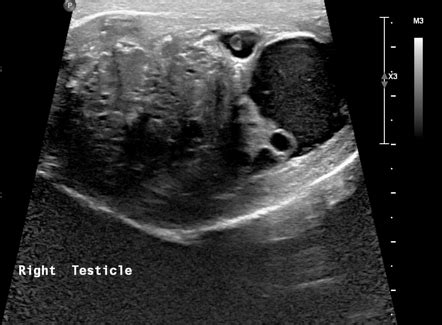 Testicular Mixed Germ Cell Tumor Radiology Case