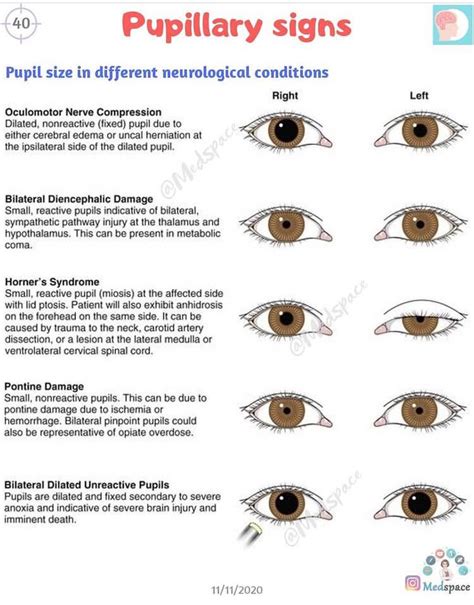 Dilated Pupils Vs Constricted Pupils