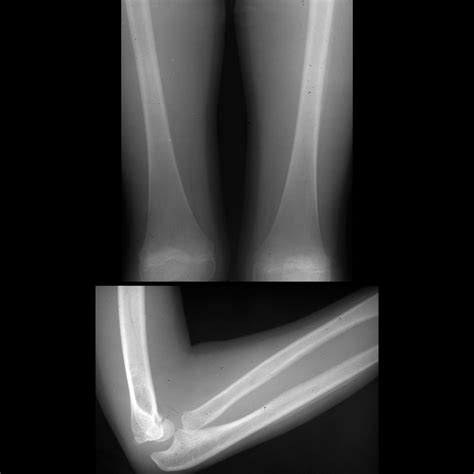 Hypervitaminosis A Pediatric Radiology Reference Article Pediatric