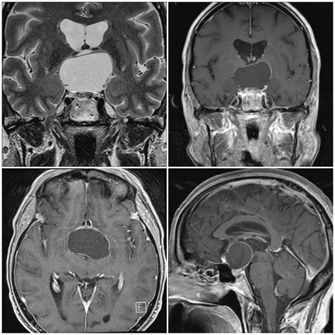 Preoperative Mri Scans Show 3x4 Cm Large Cystic Craniopharyngioma