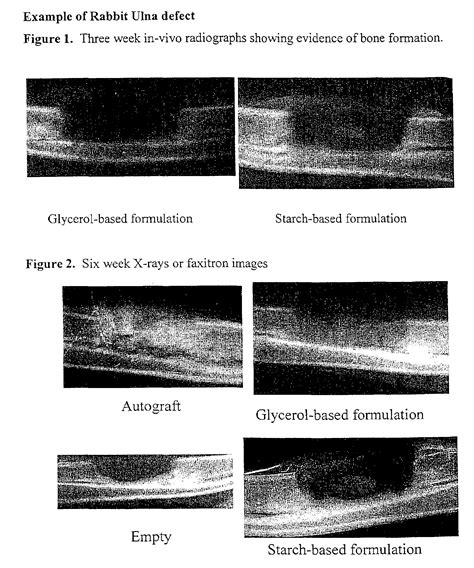Demineralized Bone Matrix Patented Technology Retrieval Search Results Eureka Patsnap