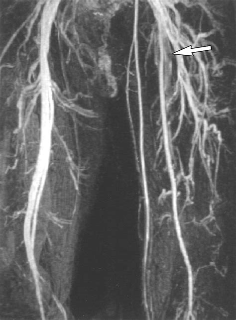 Mr Venography Using An Intravascular Contrast Agent Results From A