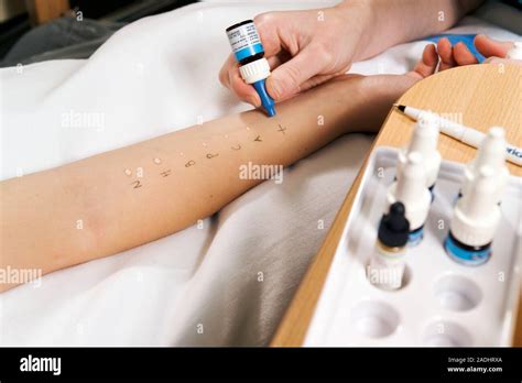 Allergy Test Arm Of A 10 Year Old Boy Undergoing A Skin Scratch
