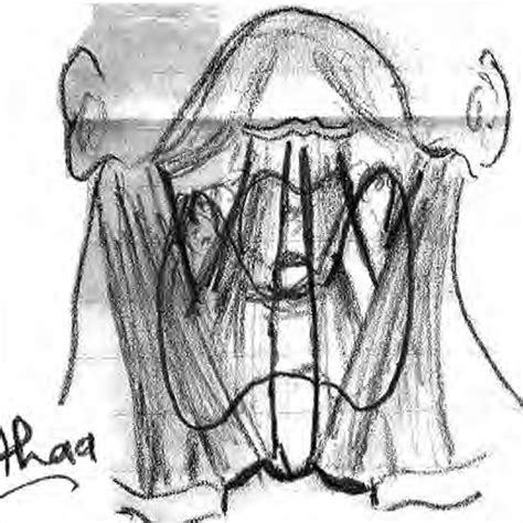 Topographic Anatomy Of The Superior Thyroid Pole Fig 2 Exposure Of Download Scientific