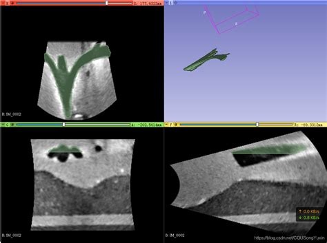 医学图像标注工具教程——从零开始使用3d slicer进行医学图像手动分割 3d slicer scissors 神仙院b栋4楼保安的博客
