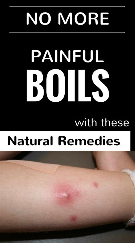 How To Treat A Chronic Boil At Tahlia Loyau Blog
