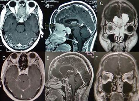 Cranial Mr Image Displaying Olfactory Groove Tumor With Nasal Cavity