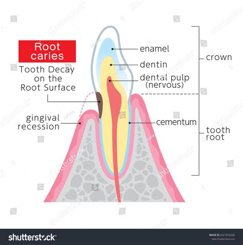 Illustration Cross Section Root Caries Since Stock Vector Royalty Free
