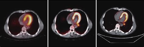 A Representative Patient With A Metastatic Mediastinal Lymph Node As Download Scientific