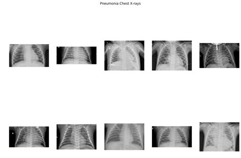 Github Timav2403detectingabnormalitiesinchestxrays