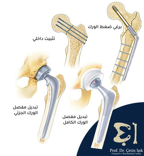 Information About Hip Replacement Operations With An Artificial Joint