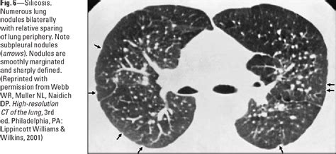 Figure From Diffuse Pulmonary Nodules Semantic Scholar