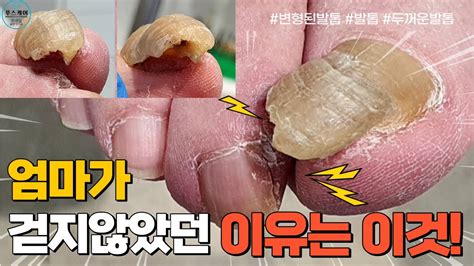두껍고 꺽여버린 발톱이 살을 찔러 걸으려하지않는 엄마를 본 따님의 빠른 결정 YouTube