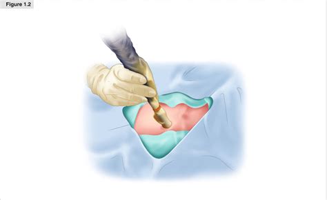 Radioguided Parathyroidectomy Oncohema Key