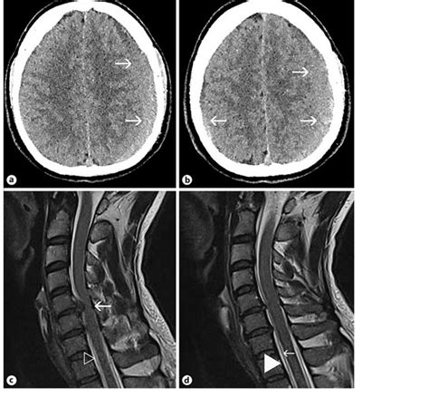 A Computerized Tomography Of The Head Showing Subacute Subdural Download Scientific Diagram