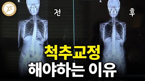 추나가 진짜 척추교정이 될까 척추교정 해야하는 이유 ㅣ 허리디스크 골반교정 추나요법 ㅣ 연산당당한방병원 Youtube