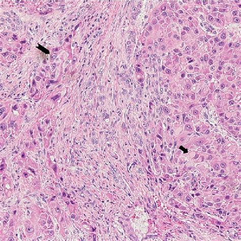 H E The Tumor Shows Sheets Of Large Oncocytic Cells Separated By Download Scientific