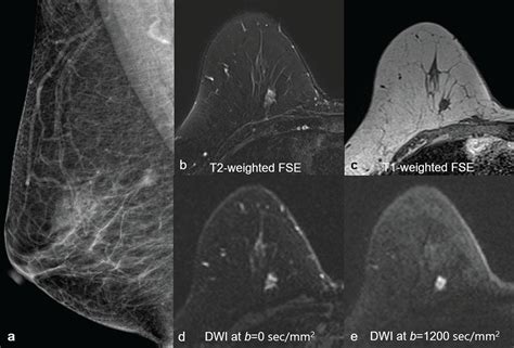 diffusion mri as a stand alone unenhanced approach for breast imaging
