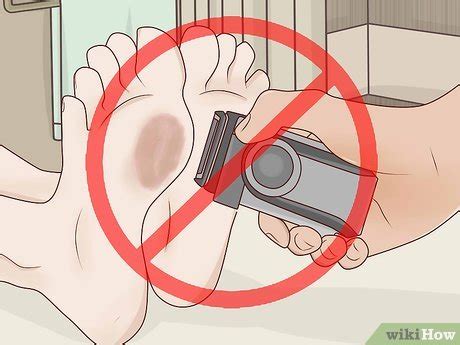 4 Ways To Remove Calluses Naturally WikiHow Health