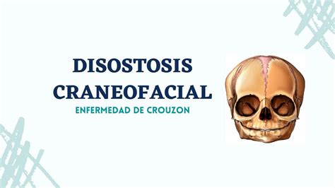 Disostosis Craneofacial Jennifer Michelle Blanch Juarez Udocz