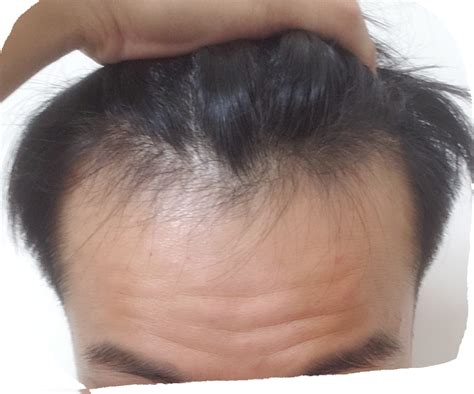 脫髮救髮。食、幫買、植髮、織髮謬誤討論暨你問我答 13 Lihkg 討論區