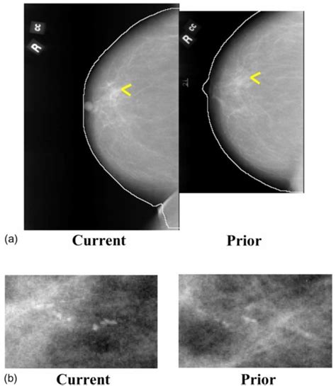 Temporally Sequential Mammograms Containing Mc Clusters A Current