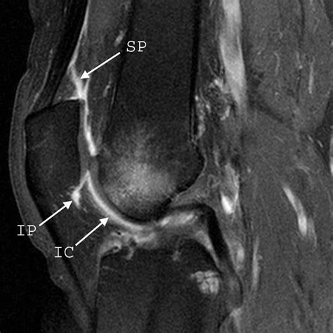 Peripatellar Synovitis Comparison Between Non Contrast Enhanced And