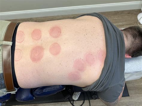 Cupping Therapy The Hetrick Center Middletown 17057