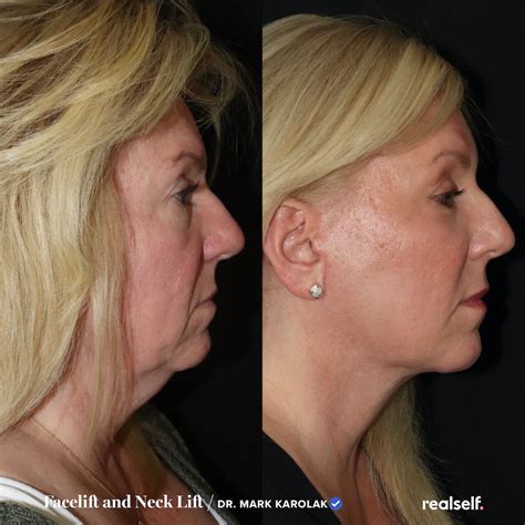 Neck Lift Surgery The Ultimate Guide Artofit